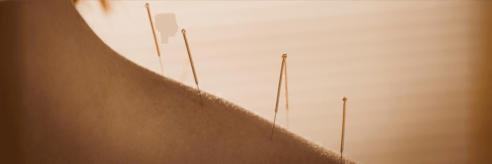 Professional Acupuncture Clinic in Mississauga